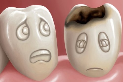 Dental Crowns and Bridges in Singapore - B & F Dental Clinic Singapore