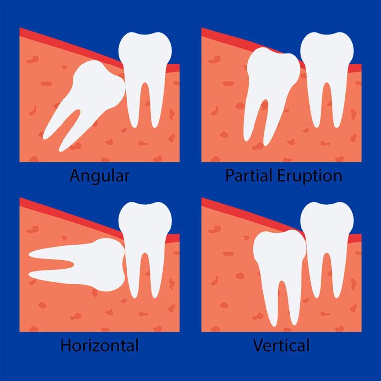 Wisdom Tooth Extraction in Singapore - B & F Dental Clinic Singapore
